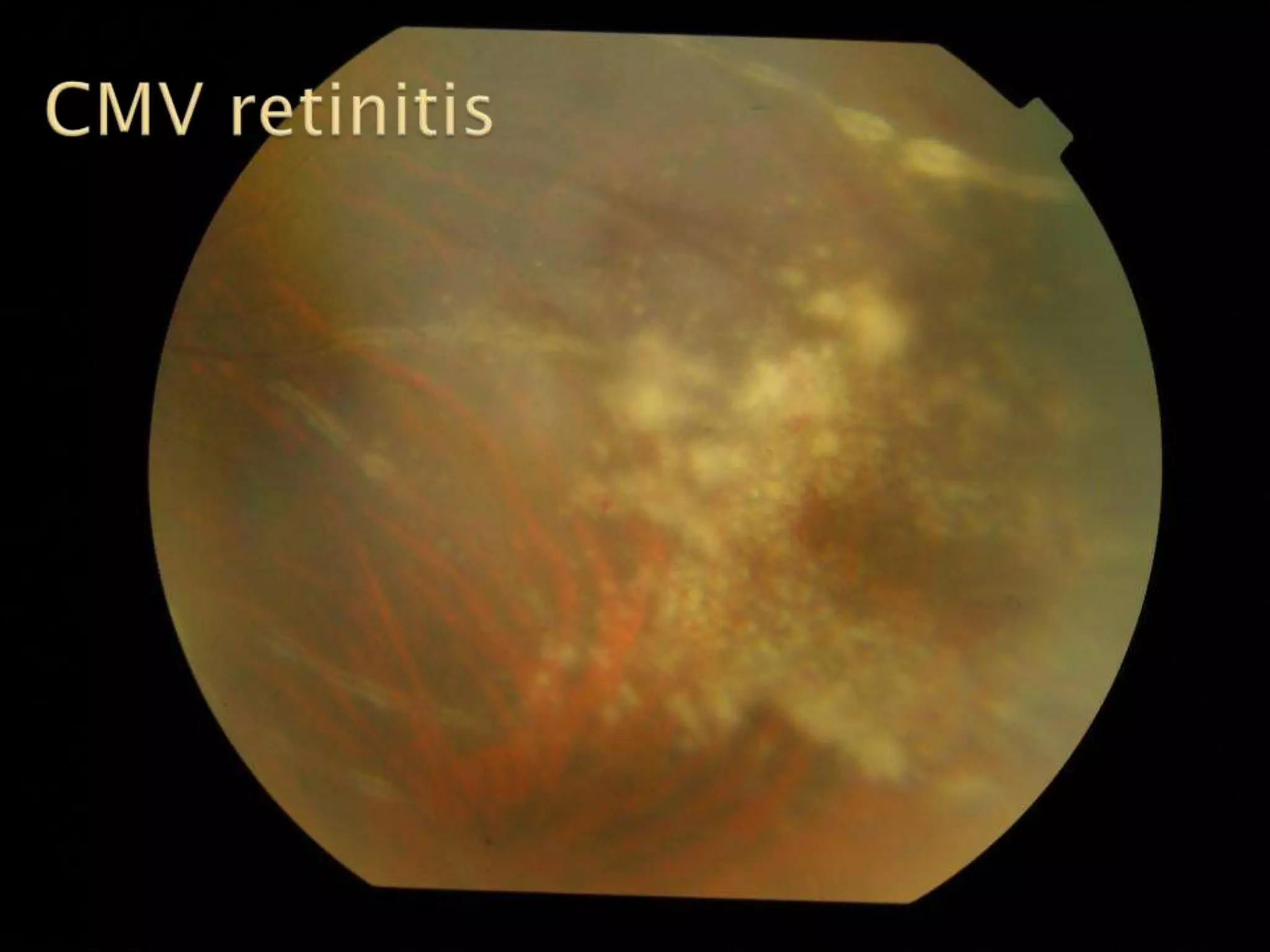 Common Causes of Uveitis Part2 | PPTX