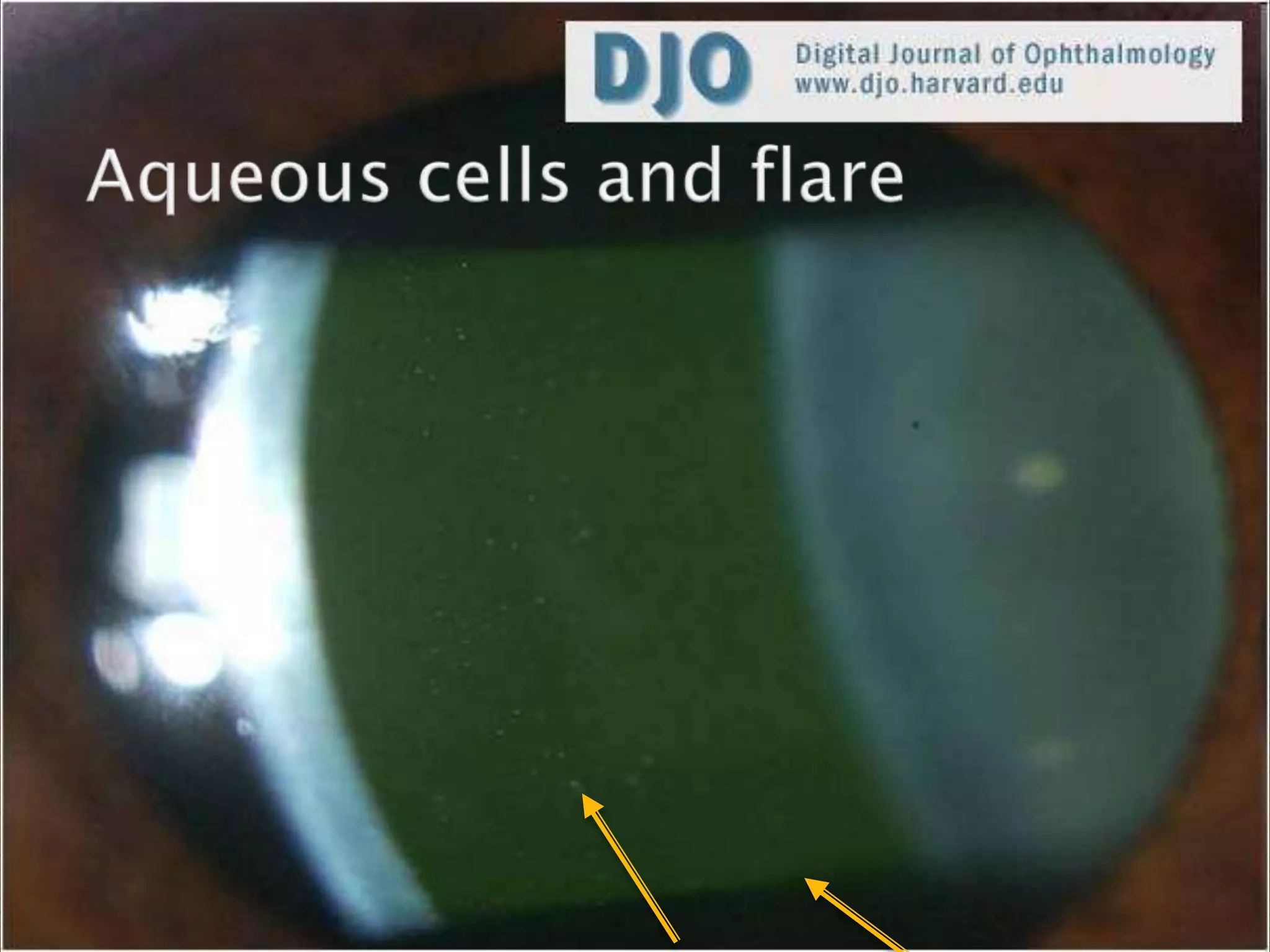 Common Causes of Uveitis Part2 | PPTX