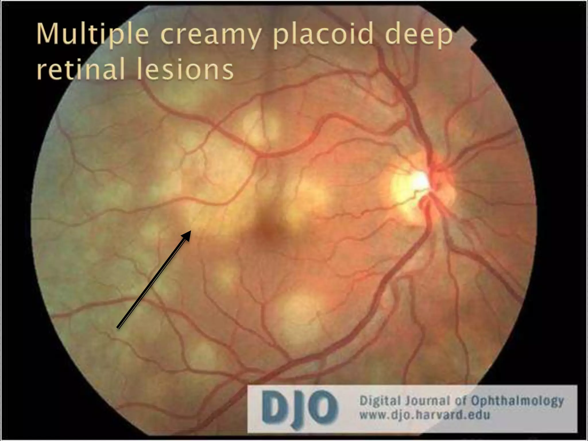 Common Causes Of Uveitis Part2 Pptx