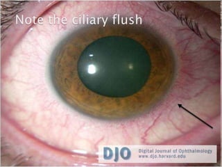 Common Causes of Uveitis Part2 | PPTX