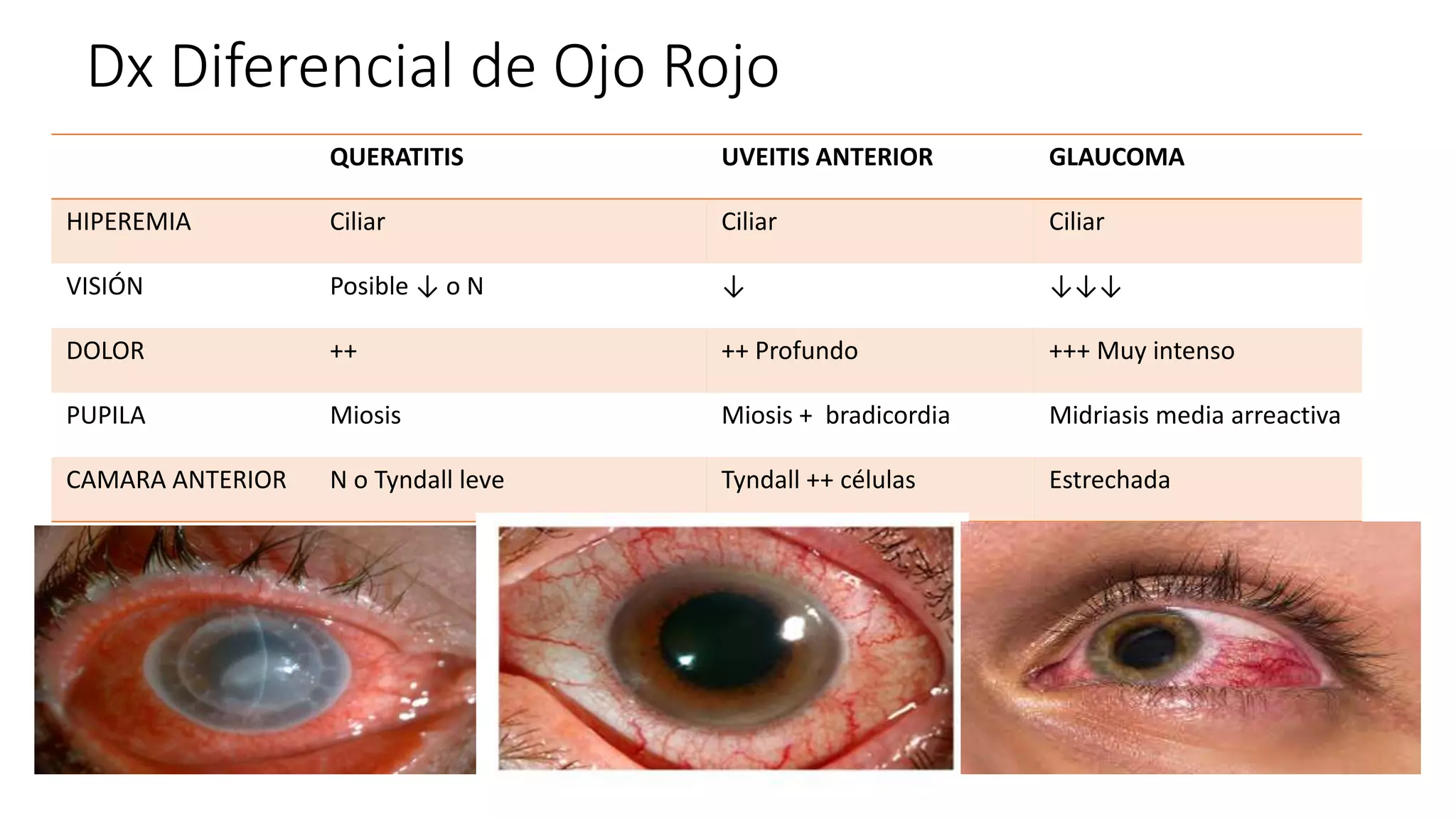 Uveitis | PPTX