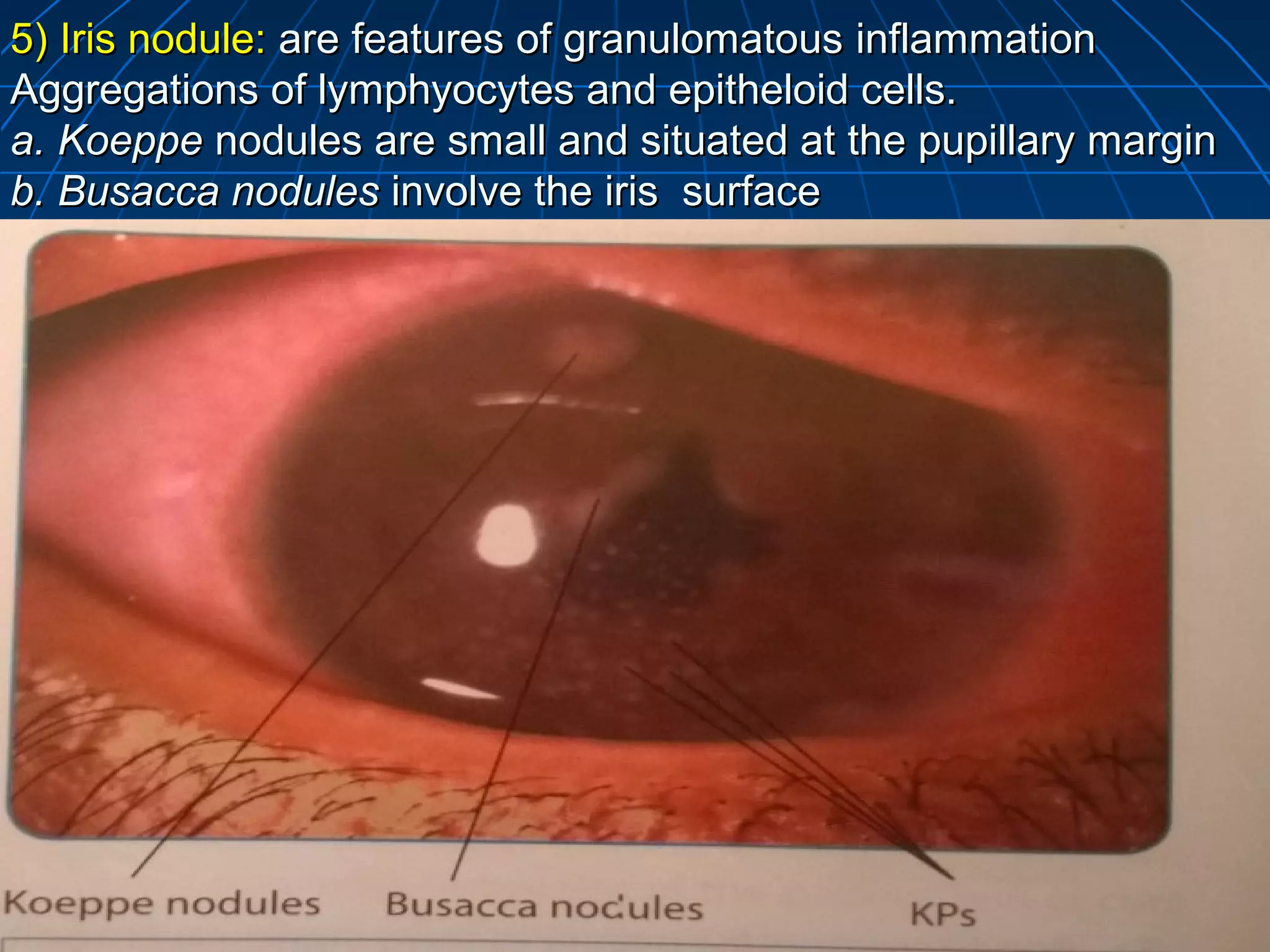 Uveitis Eye presentation- Darayus | PPT