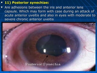 Uveitis Eye presentation- Darayus | PPT