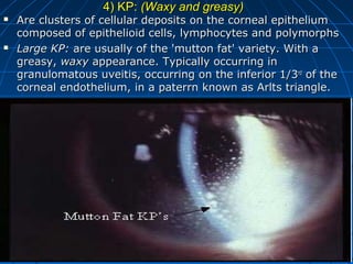 Mutton Fat Keratic Precipitates
