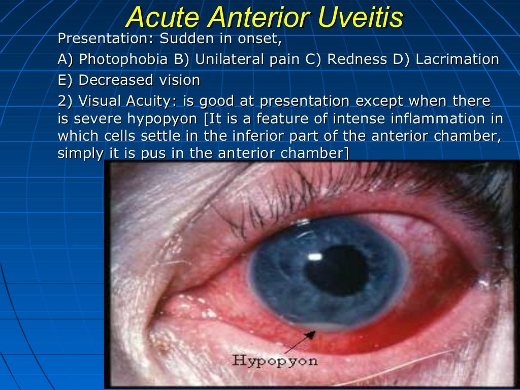 Uveitis Eye presentation- Darayus