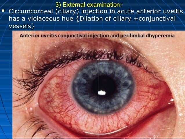 Uveitis Eye Presentation Darayus