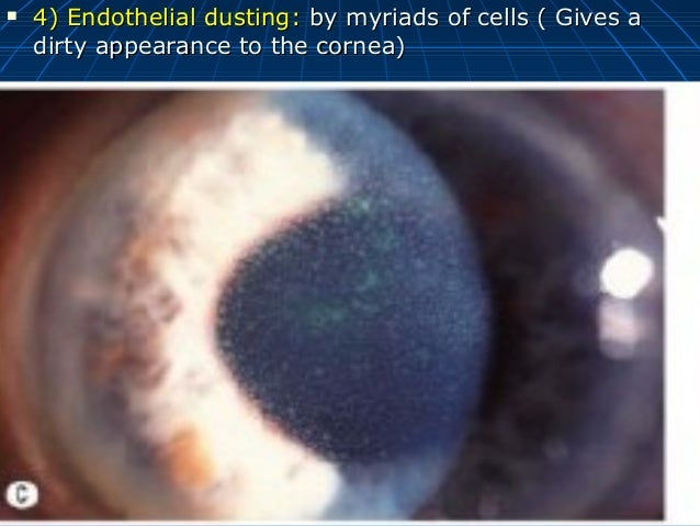 Uveitis Eye Presentation Darayus