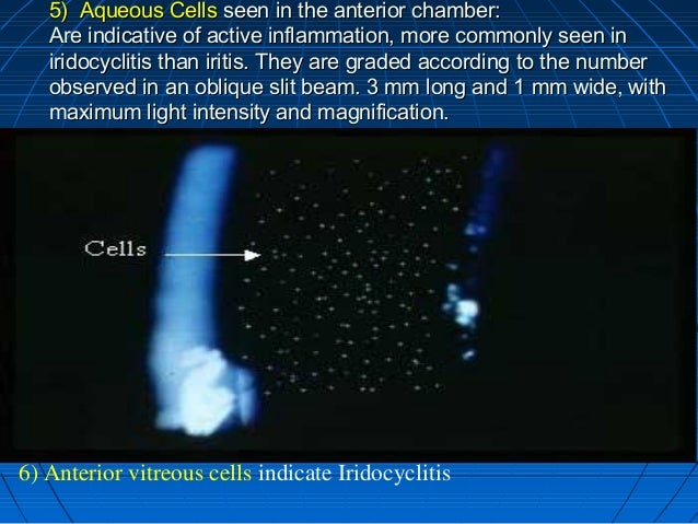 Uveitis Eye presentation- Darayus