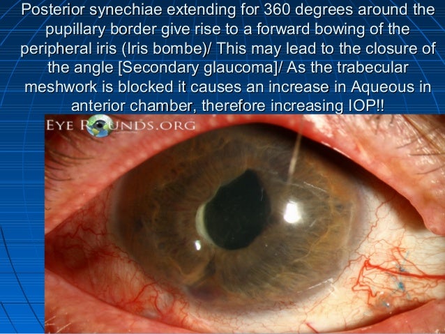 Uveitis Eye Presentation Darayus