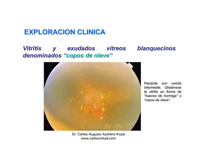 Uveitis Intermedia