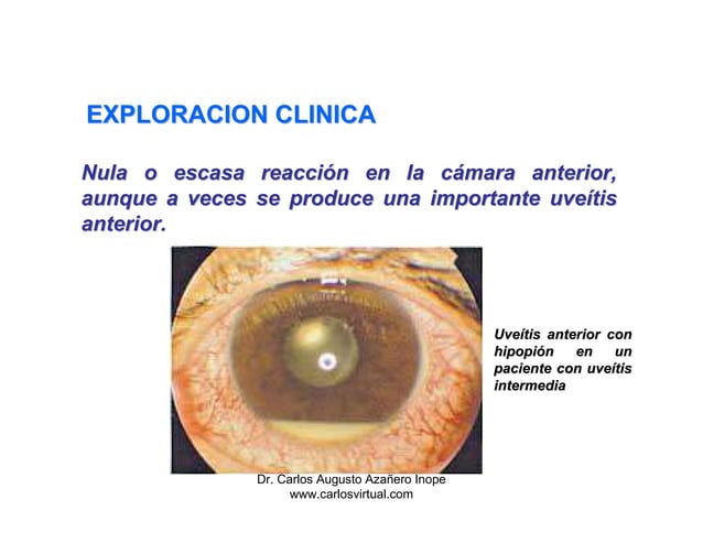 Uveitis Intermedia