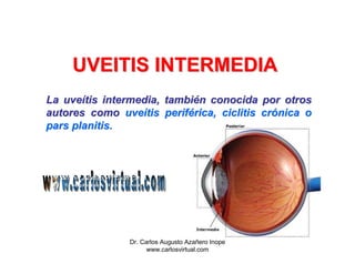Uveitis Intermedia | PPT