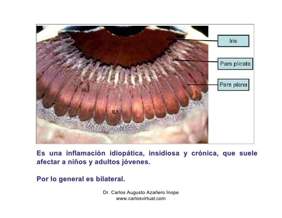 Uveitis Intermedia