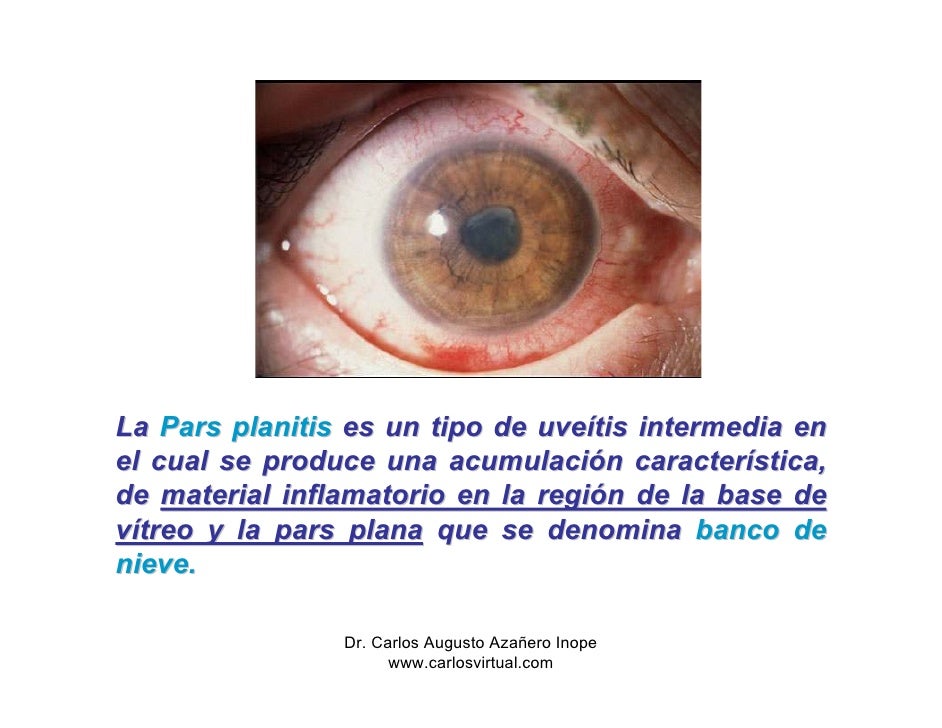 Uveitis Intermedia