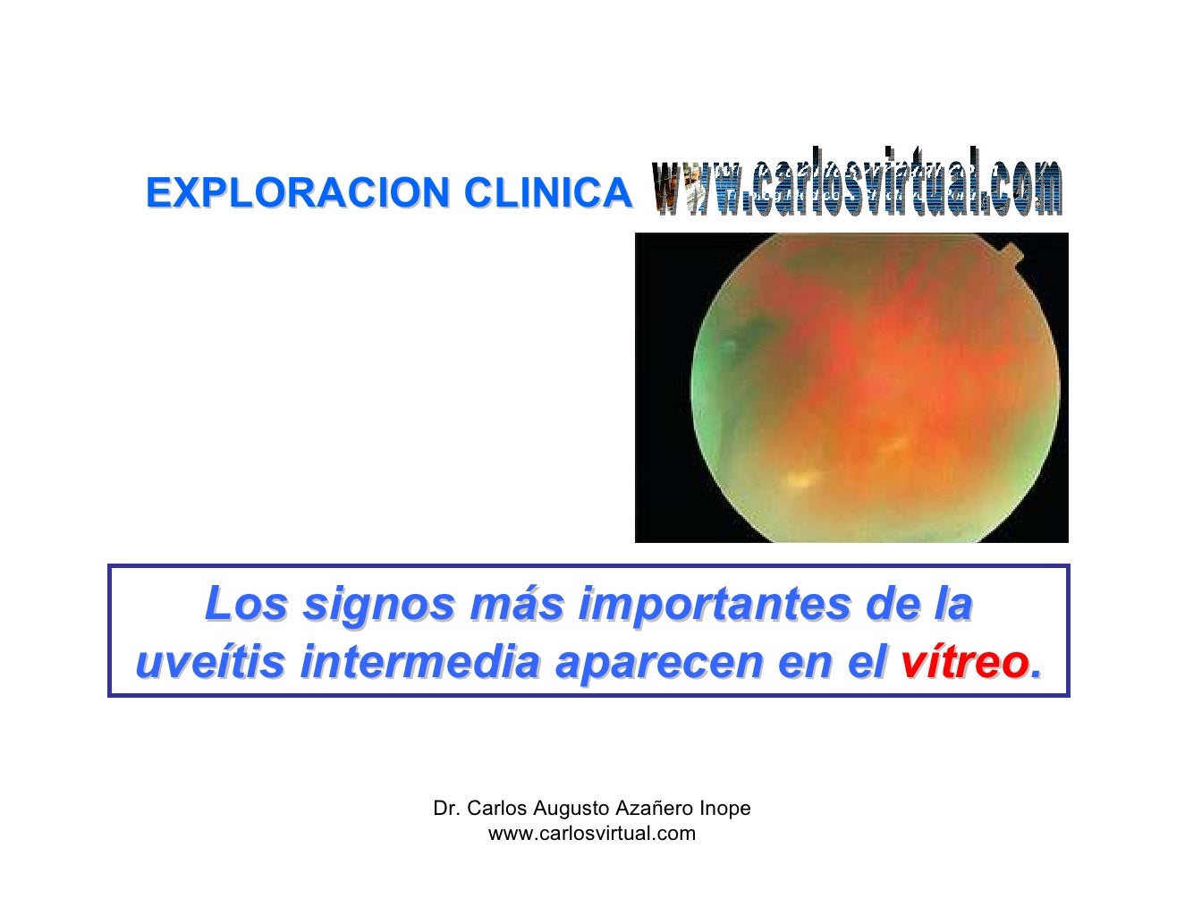 Uveitis Intermedia