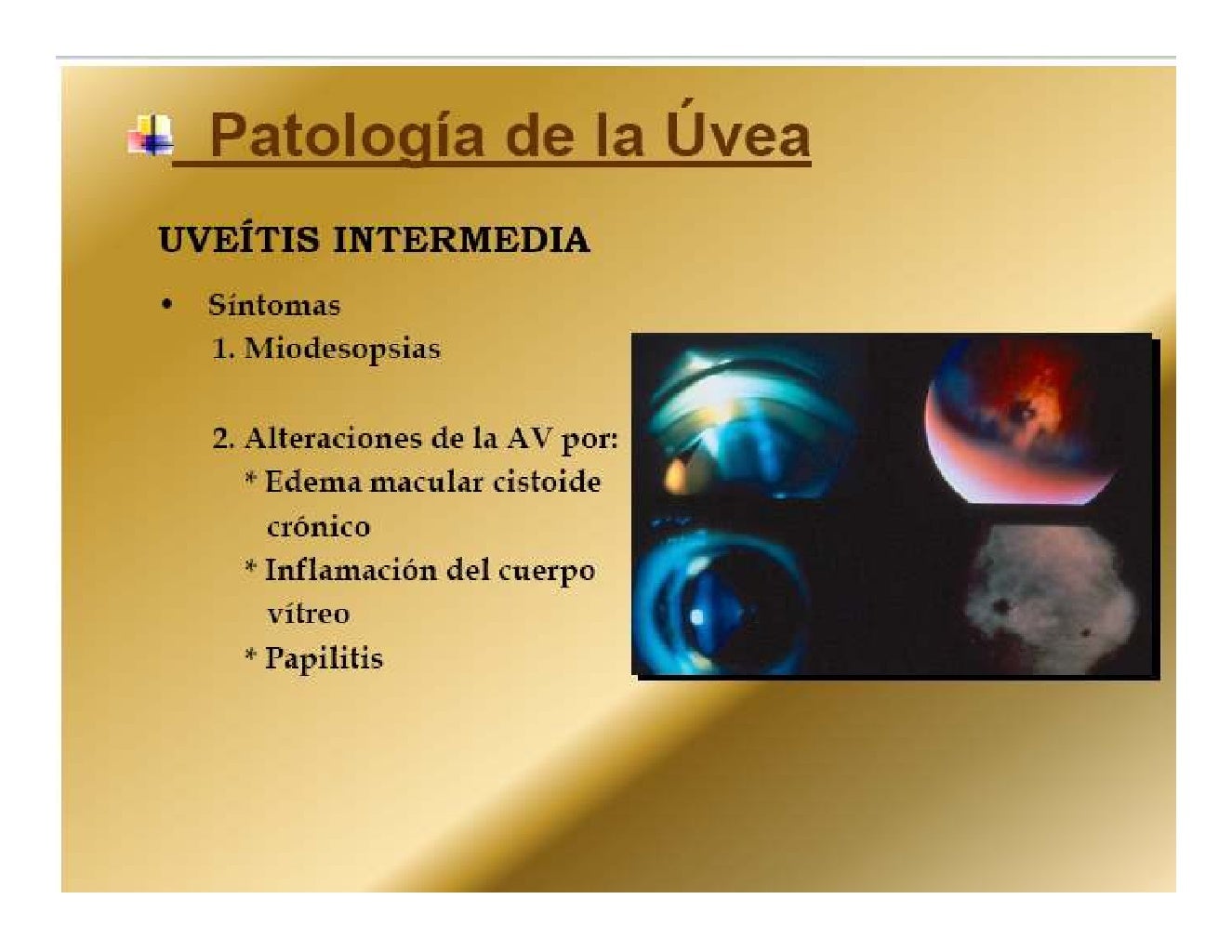 Uveitis Intermedia
