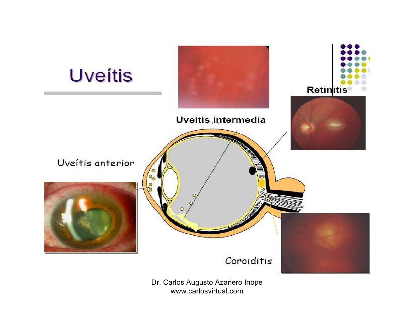 Uveitis