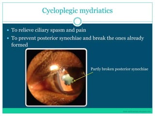 Uveitis management .pdf treatment diagnosis | PDF | Medical Tests ...