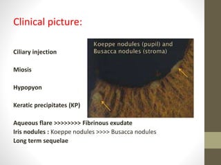 Uveitis part 2 | PPTX