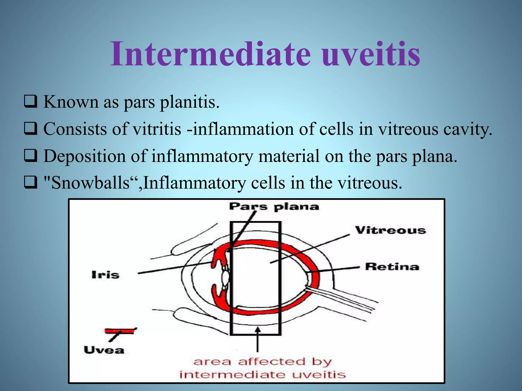 Uveitis ppt | PPTX | Eye and Vision Conditions | Diseases and Conditions