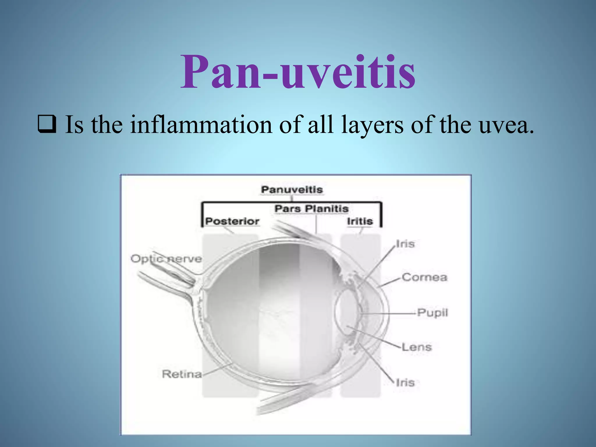 Uveitis ppt | PPTX