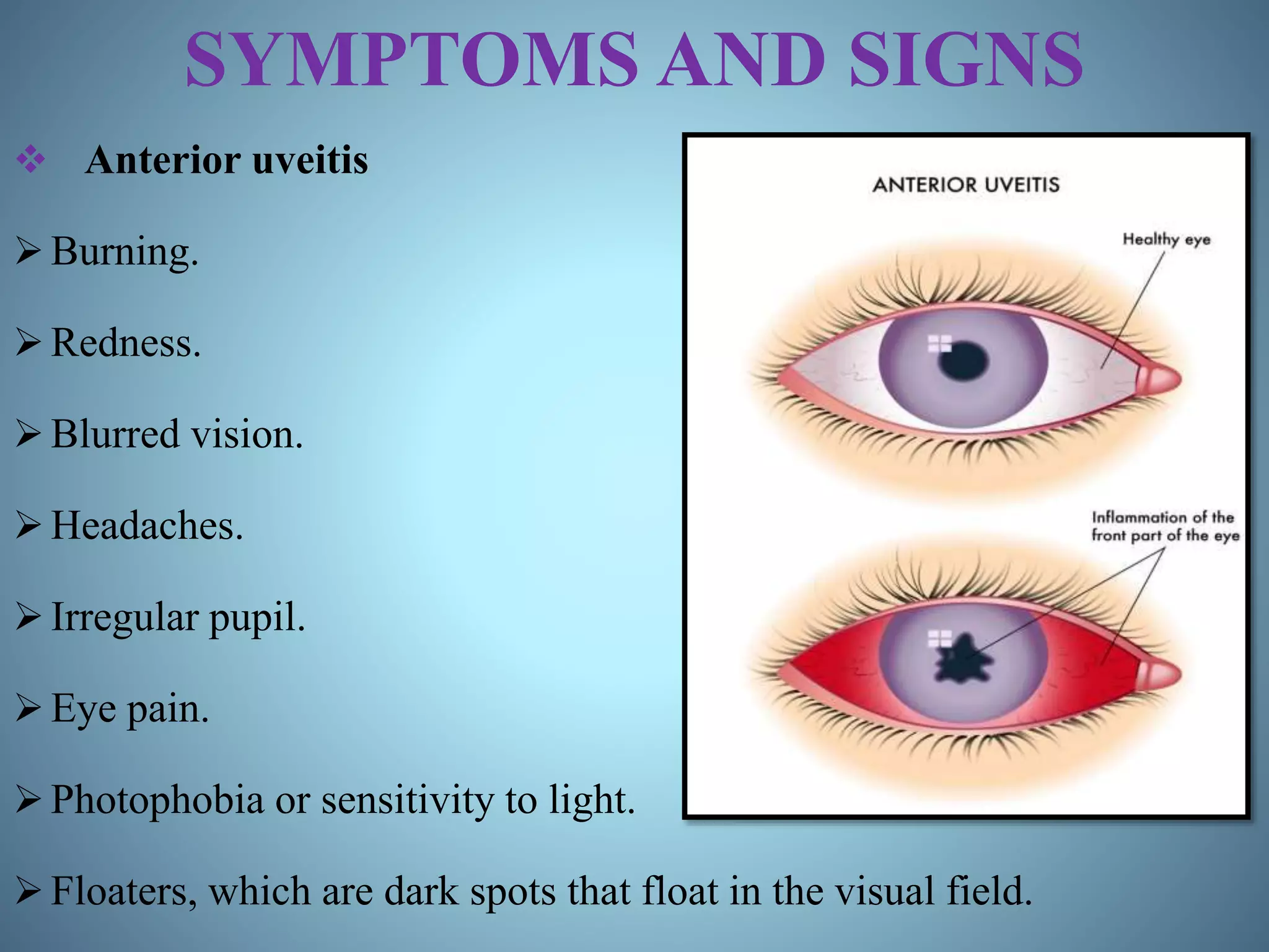 Uveitis ppt | PPTX
