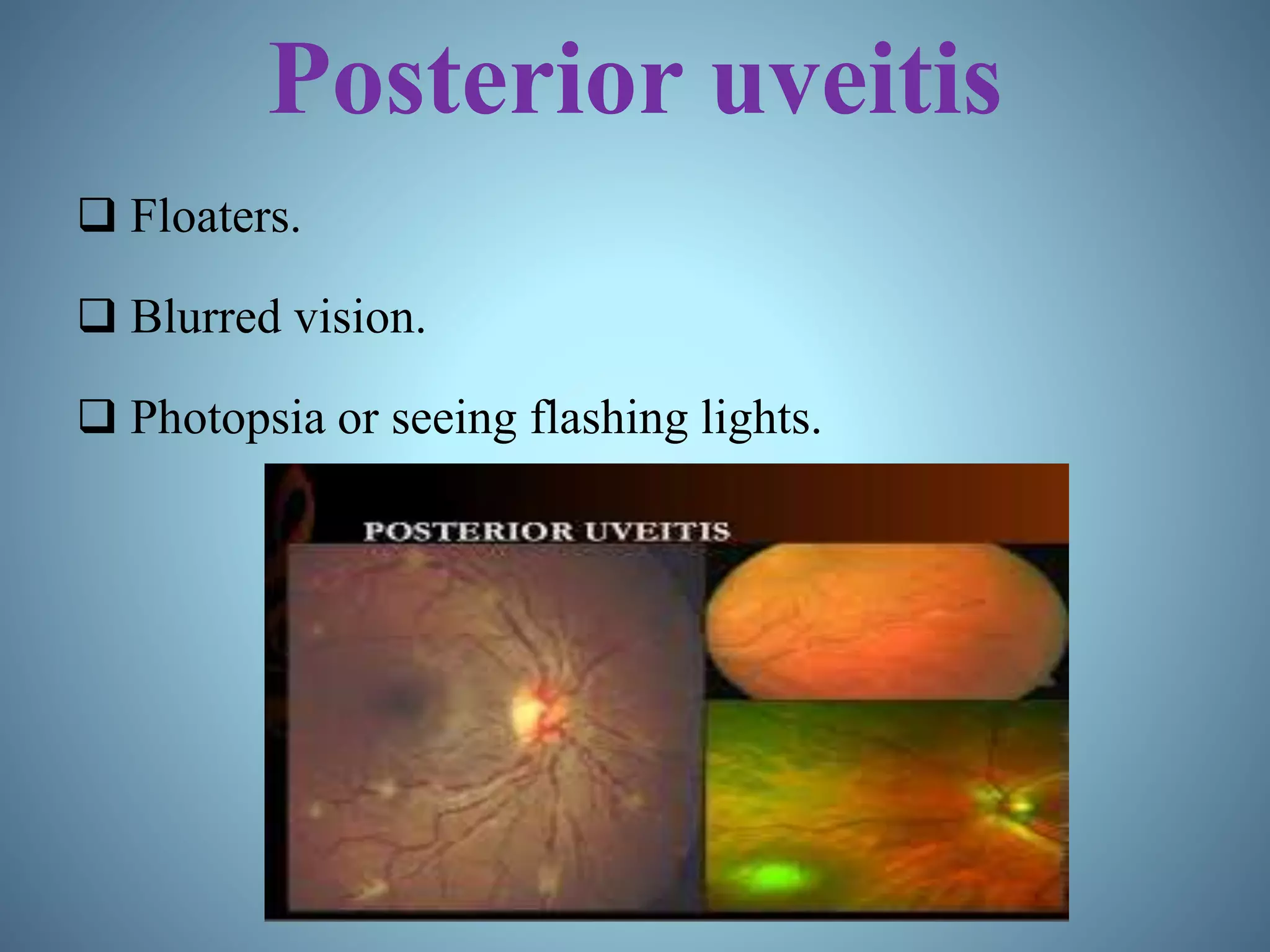 Uveitis ppt | PPTX