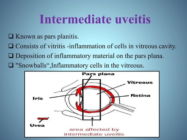 Uveitis ppt | PPTX | Eye and Vision Conditions | Diseases and Conditions