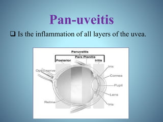 Uveitis ppt | PPTX