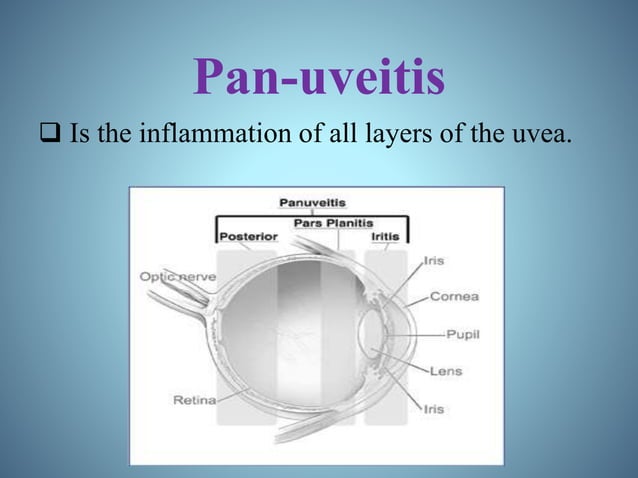 Uveitis ppt | PPTX | Eye and Vision Conditions | Diseases and Conditions