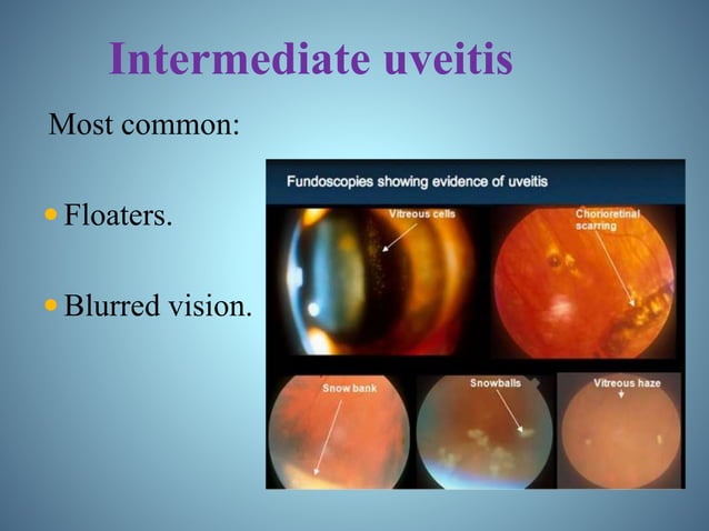 Uveitis ppt | PPTX | Eye and Vision Conditions | Diseases and Conditions