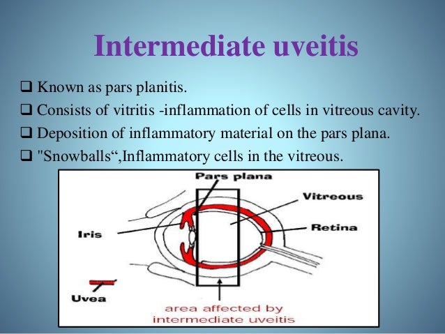 Uveitis ppt