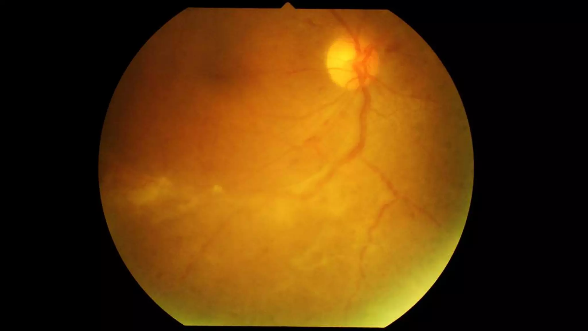 Uveitis quiz (masquerade syndrome) | PPTX