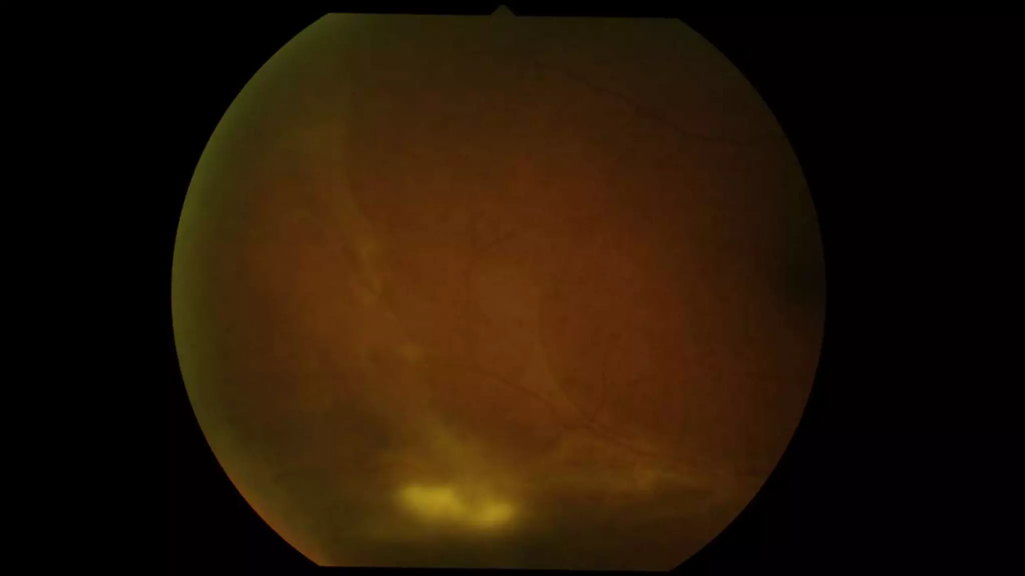 Uveitis quiz (masquerade syndrome) | PPTX