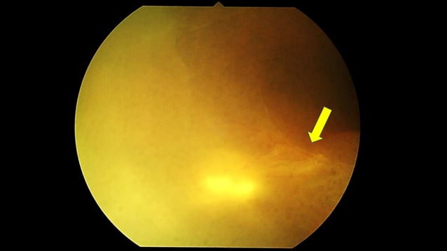 Uveitis quiz (masquerade syndrome) | PPTX