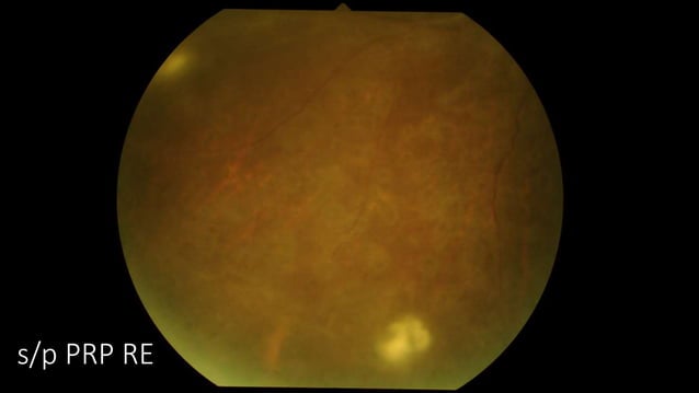 Uveitis quiz (masquerade syndrome) | PPTX