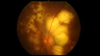 Uveitis quiz (masquerade syndrome) | PPTX