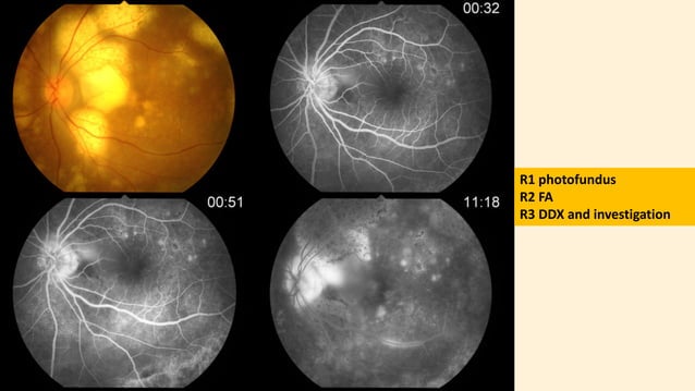 Uveitis quiz (masquerade syndrome) | PPTX