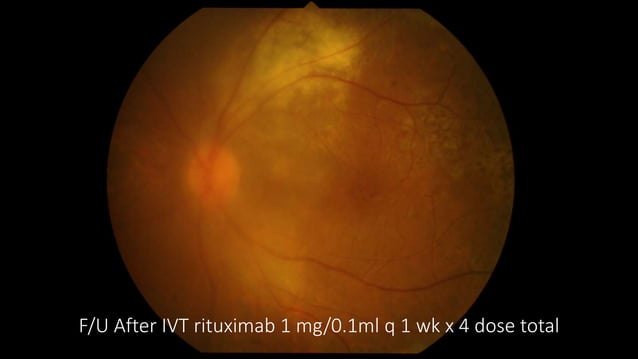 Uveitis quiz (masquerade syndrome) | PPTX