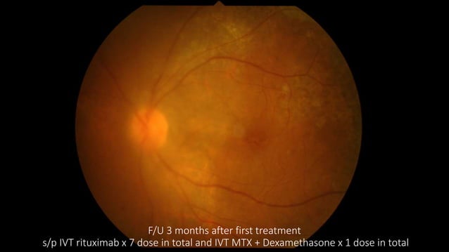 Uveitis quiz (masquerade syndrome) | PPTX