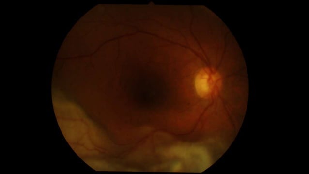 Uveitis quiz (masquerade syndrome) | PPTX