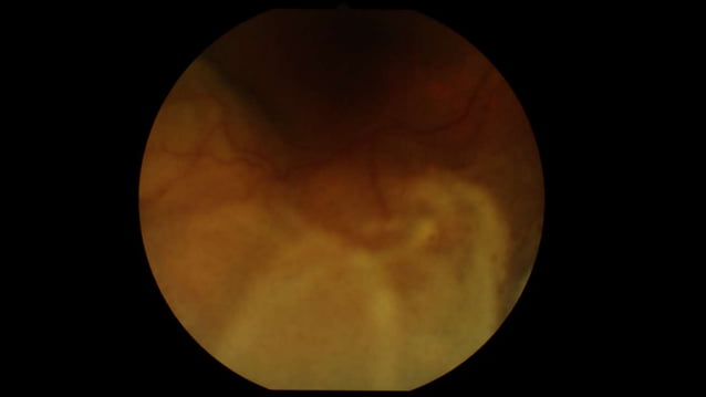 Uveitis quiz (masquerade syndrome) | PPTX