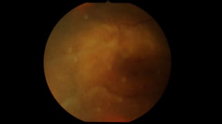 Uveitis quiz (masquerade syndrome) | PPTX
