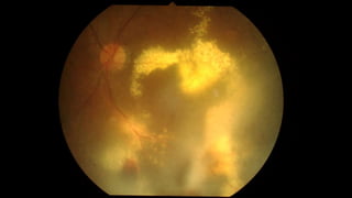Uveitis quiz (masquerade syndrome) | PPTX