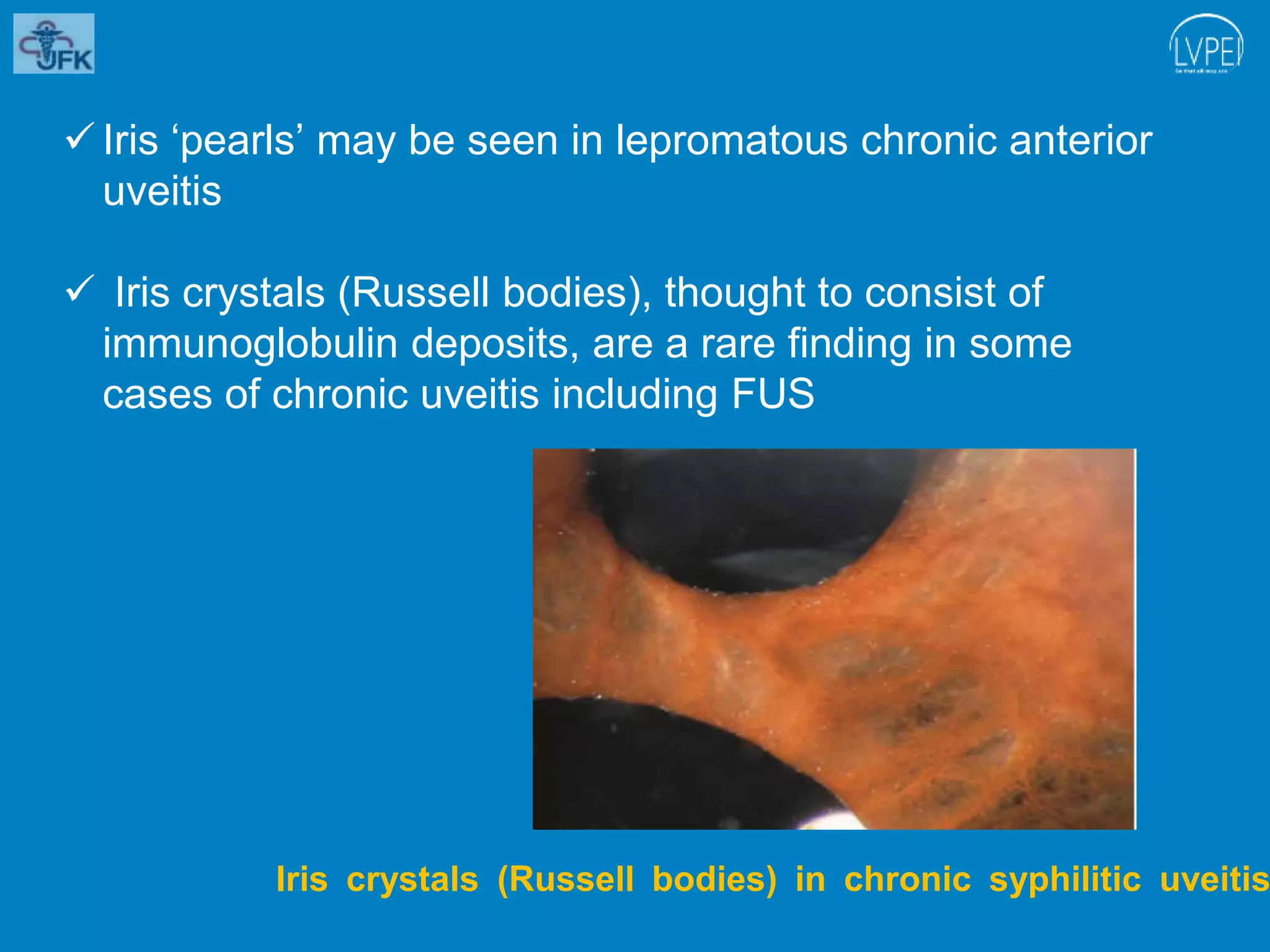 Uveitis signs and symptoms.pptx