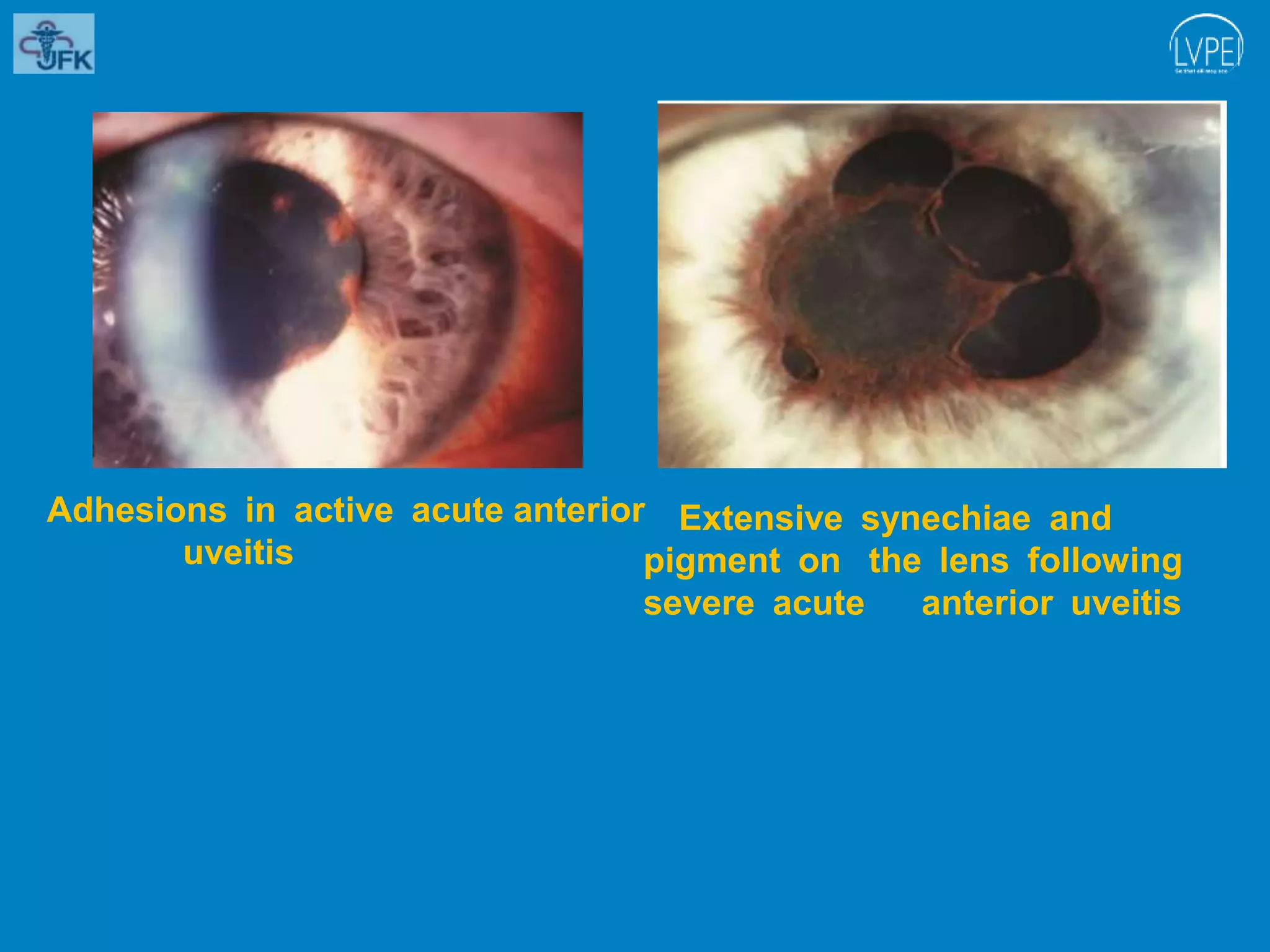 Uveitis signs and symptoms.pptx