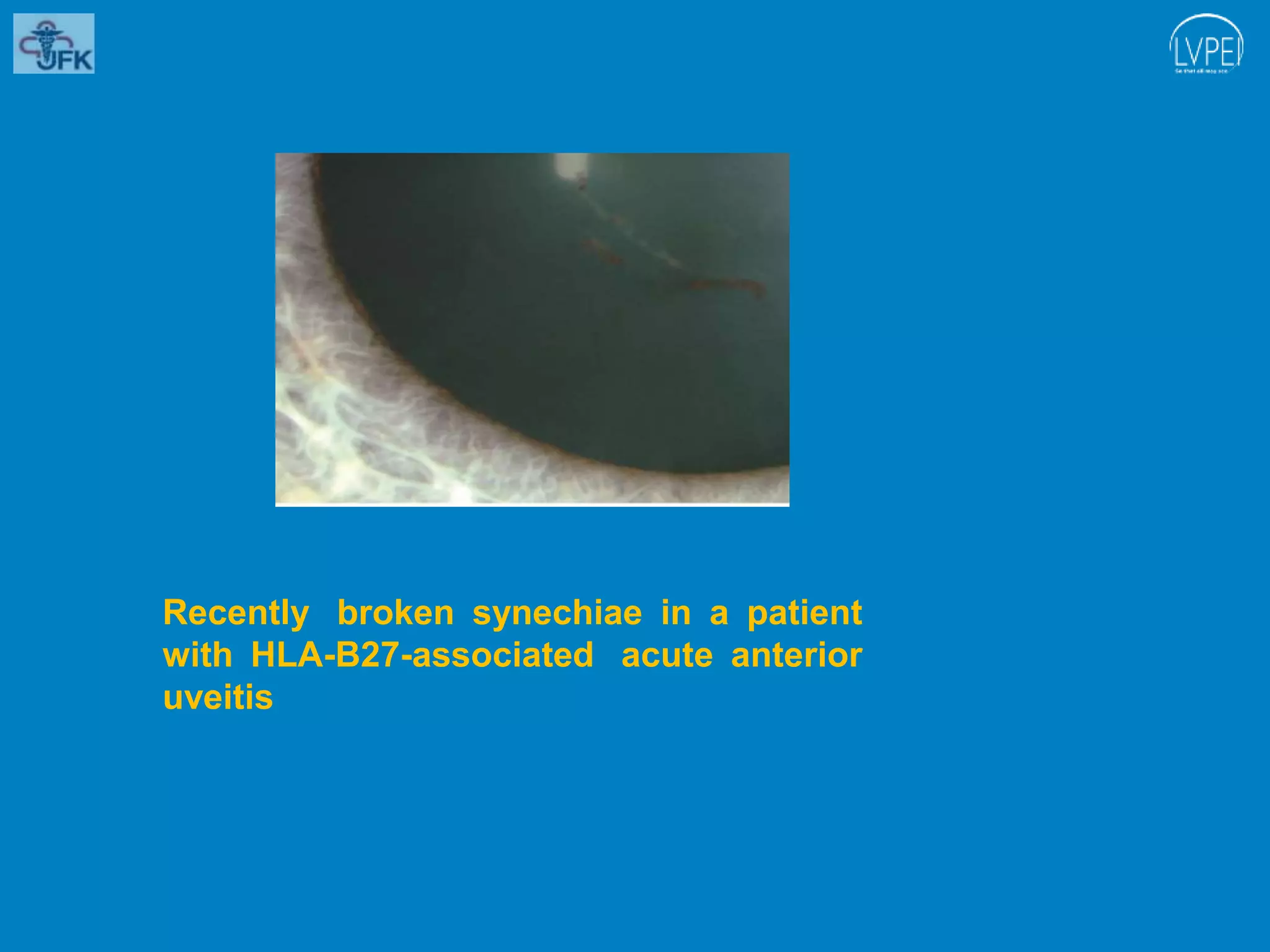 Uveitis signs and symptoms.pptx