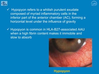 Uveitis signs and symptoms.pptx