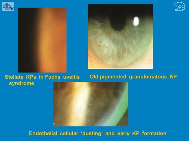 Uveitis signs and symptoms.pptx