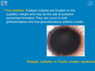 Uveitis signs and symptoms.pptx